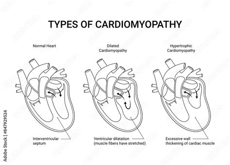 Types Of Cardiomyopathy Sketch Illustration Medical Design Stock Vector