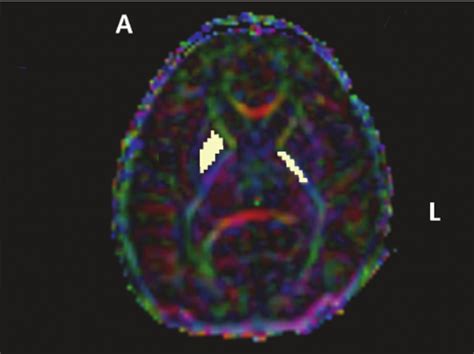 Pp And Plic White Squares Region Of Interest Positioning On Native