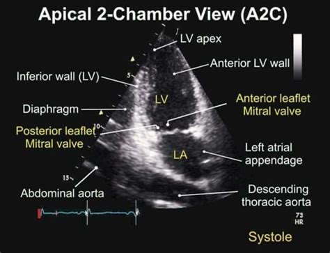 Apical 2 Chamber View Tee
