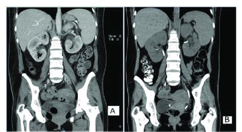 A Ct Scan Showing Emphysematous Pyelonephritis And Cystitis B Ct Download Scientific Diagram