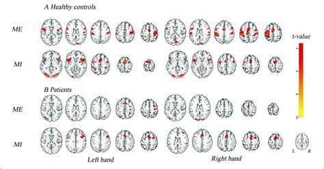 Activation Map Brain Activity In Different Experimental Conditions
