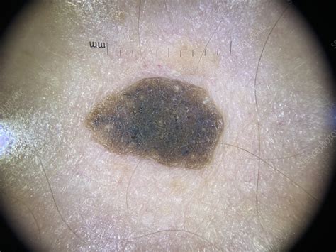 Seborrheic Keratosis Dermoscopy Stock Image C0572323 Science