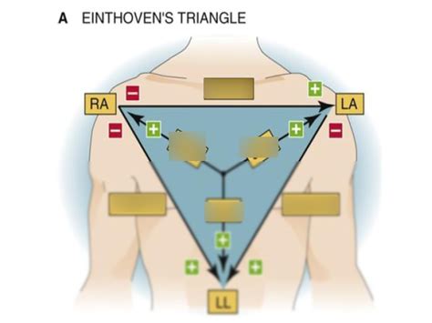 Einthovens Triangle Diagram Quizlet