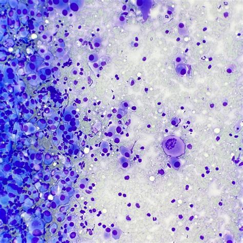 Lymph Node Fna R Pathology