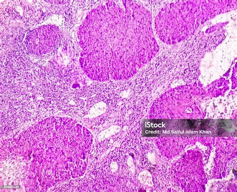 Photomicrograph Showing Tongue Squamous Cell Carcinoma Grade Ii Oral