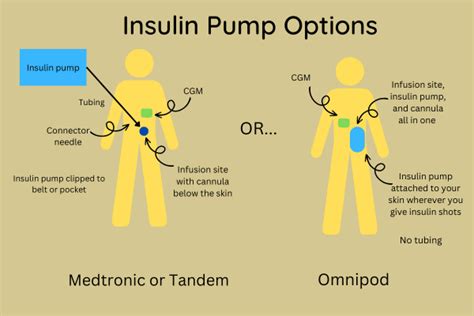 Diabetes Insulin Pump A Complete Guide To Getting Started