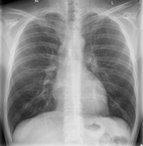 Normal Chest Radiograph Diagram Quizlet