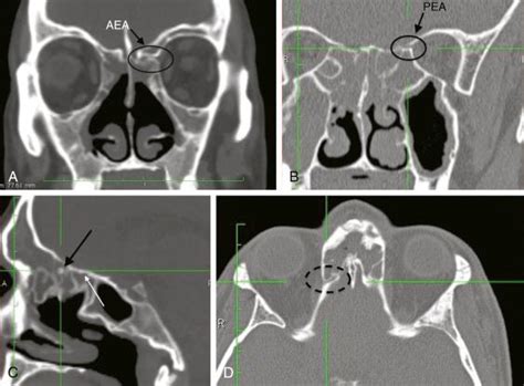 Endoscopic And Open Anteriorposterior Ethmoid Artery Ligation