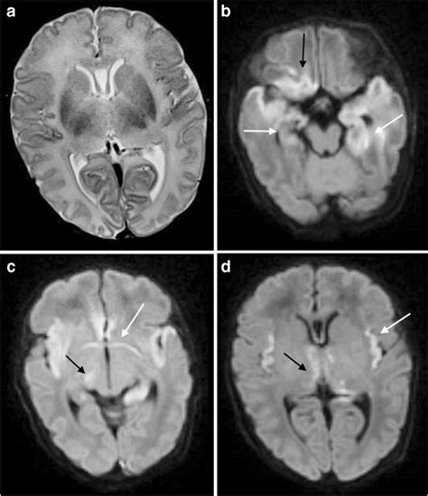 Herpes Simplex Virus Type 2 Encephalitis In A 16 Day Old Girl The Mri