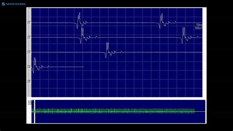 Kimura And Kohara F53 Polyphasic Mup Showing Satellite Potentials Youtube
