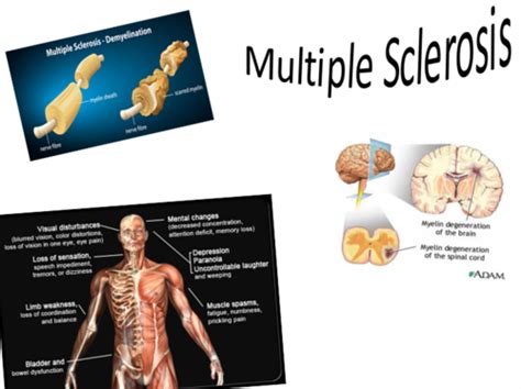 Ms Mulitple Scleorisis Flashcards Quizlet