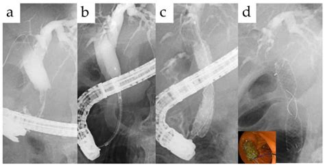 Stent Placement Method Following Insertion Of The Guidewire Via The Download Scientific