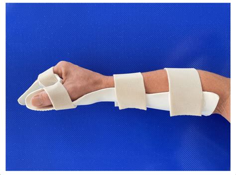 Splint To Ensure The Intrinsic Plus Position Of The Hand Download