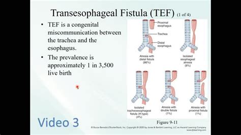 3 Transesophageal Fistula