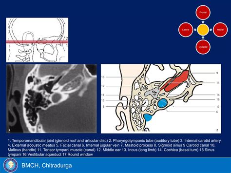 Cochlear Implant Imaging Ppsx