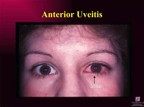 Anterior Uveitis Ppt