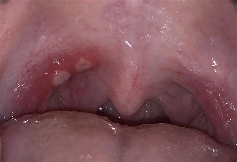 Soft Palate Canker Sore