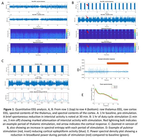 Amplitude Dependent Suppression Of Interictal Epileptiform Activity By