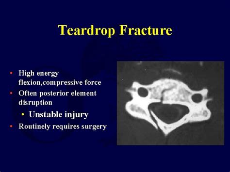 Subaxial Cervical Spine Trauma Lisa K Cannada Md