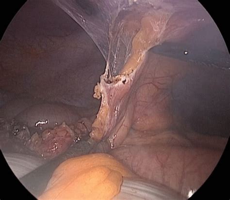 The Preperitoneal Plane Is Dissected And The Round Ligament Is