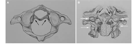 The Transverse Atlantal Ligament Arches Across The Ring Of The Atlas