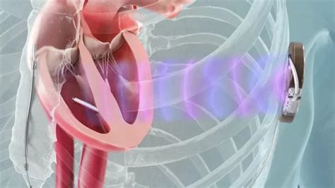 Completely Leadless Cardiac Rhythm Management System Impresses