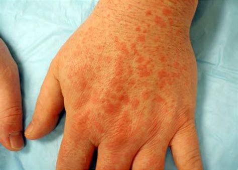 Erythematous Rash