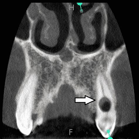 Cone Beam Computed Tomographic Scan Of The Resorption Site Download Scientific Diagram