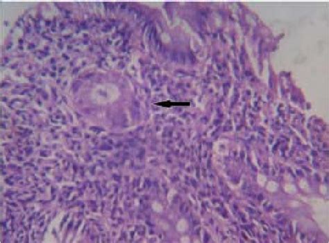 Figure 1 From Flare In Ulcerative Colitis Is Not Always Relapse Semantic Scholar