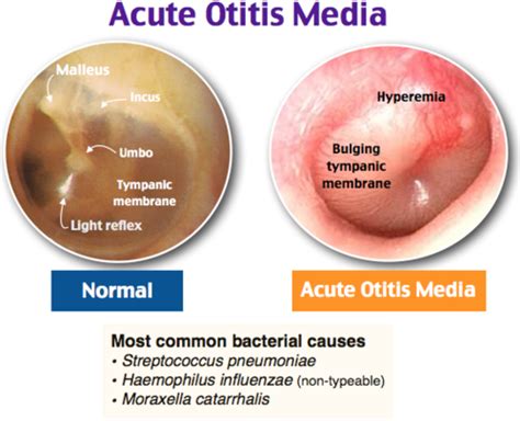 Normal Eardrum Vs Otitis Media