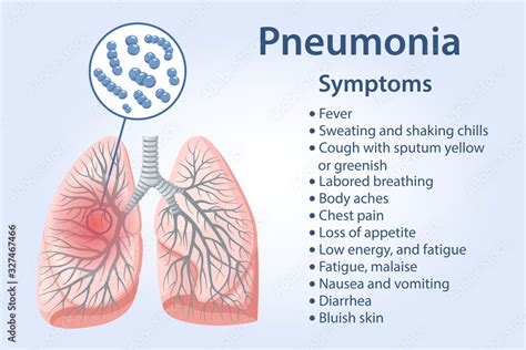 Streptococcus Pneumoniae Diagram