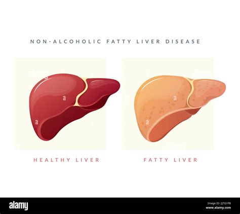 Liver With Liver Cell And Fat Cells Stock Illustration As Eps 10 File Stock Vector Image And Art