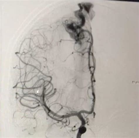 Dan Meila Prof Dr Med On Linkedin Complete Embolization Of A Ruptured Brain Avm In A 9 Year