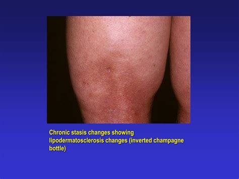 Ppt Venous Stasis Dermatitis Powerpoint Presentation Free Download Id 6529632