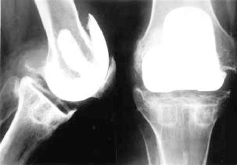 Figure 1 From Filling Of Segmental Bone Defects In Revision Knee Arthroplasty Using Morsellized