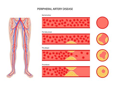 7114 Peripheral Arterial Disease
