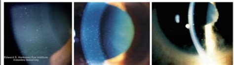 Anterior Uveitis Flashcards Quizlet