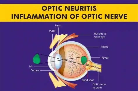 Optic Nerve Acute Optic Nerve Infarction Demonstrated By
