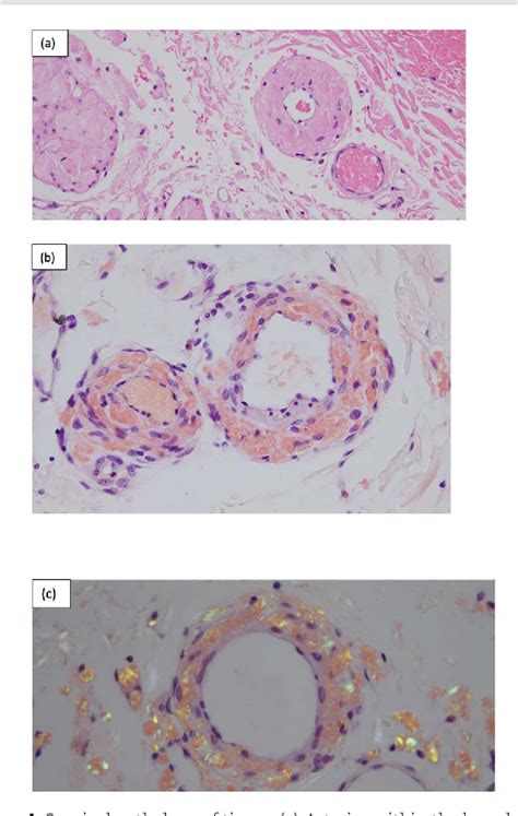 Figure 4 From A Rare Cause Of Colonic Pseudo Obstruction Due To Light Chain Amyloidosis