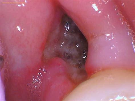 Infected Tooth Socket