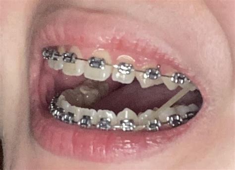 Ipr Or A Single Premolar Extraction R Braces