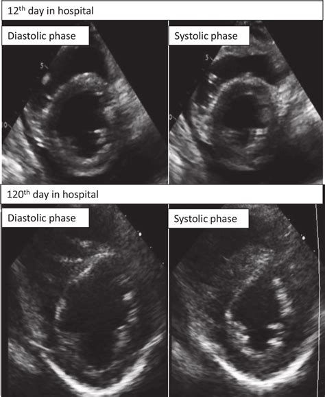 Clinical Course Of Cardiomyopathy Echocardiogram Mild Diffuse