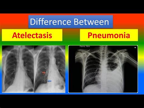 Atelectasia Vs Pneumotorax Eventration Of The Diaphragm Presenting As