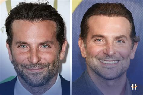 Bradley Cooper Plastic Surgery Bradley Cooper Face Lift Hop Health