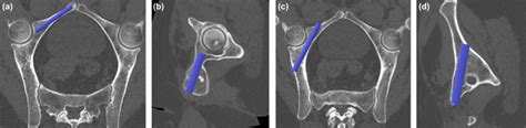 Medial And Lateral Intramedullary Osseous Fixation Corridors In Ct Download Scientific Diagram