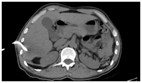 simple axial projection abdominal tomography insertion and drainage