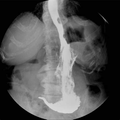 Upper Gi Fluoroscopy To Assess The Results Of The Hernia Repair During