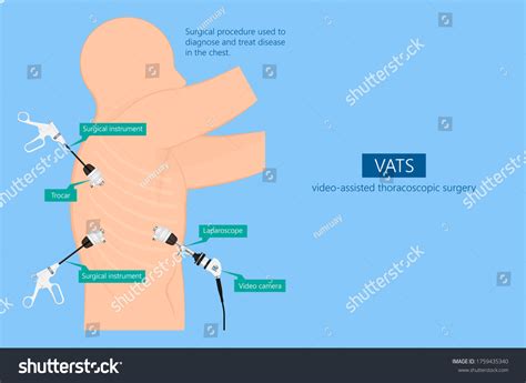 Lobectomy Images Photos Et Images Vectorielles De Stock Shutterstock