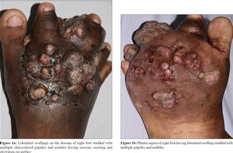 Cutaneous Botryomycosis Treated Successfully With Injectable Ceftriaxone Sodium In An