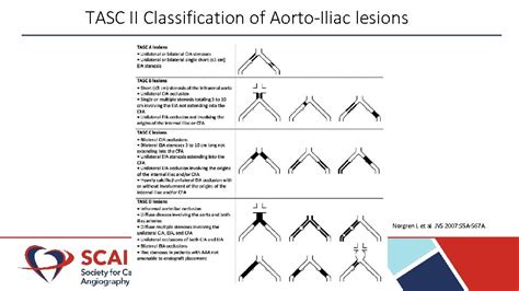 Scai Guidelines On Device Selection In Aortoiliac Arterial